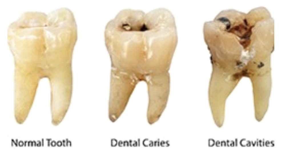 WHAT DO YOU KNOW ABOUT CAVITIES? | Dentist Scarborough, Toronto, ON